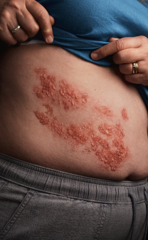 Symptômes du Zona - Reconnaître Les Signes | Demain Santé